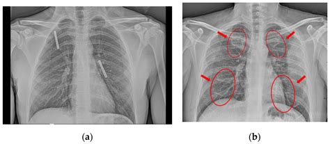 Chest X Ray Pneumonia