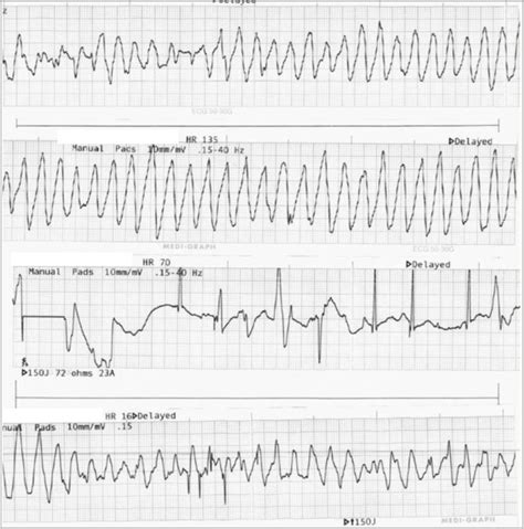 Lethal Arrhythmia Induced By Licorice Lethal Arrhythmia Induced By Licorice