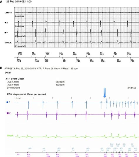 A Stored Icd Electrogram Demonstrating Af That Coincided With The