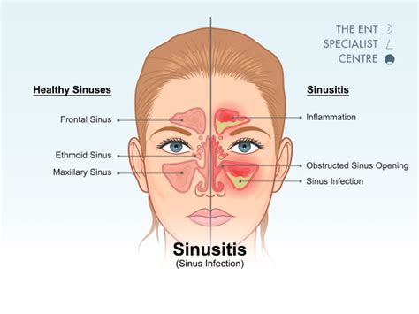 Maxillary Sinus Infection Acute Sinusitis A Cost Effective Approach