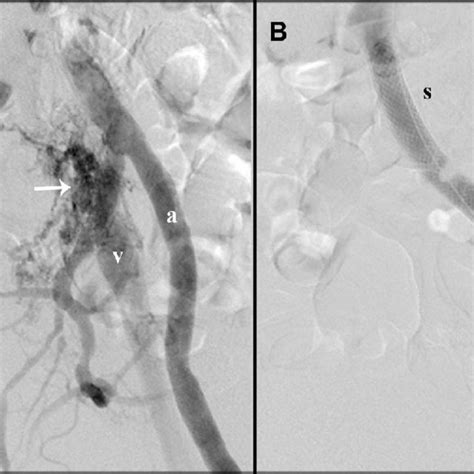 Venous Duplex Doppler Examination Both The Left Common Femoral Vein