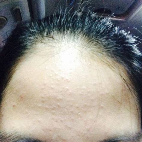 脸上长小米粒疙瘩是怎么回事可能是这4种皮肤病 搜狐大视野 搜狐新闻