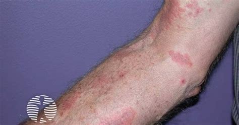 Dermnet® Plant Dermatitis Image