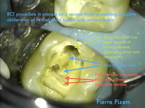Calcification Of Teeth Roots Teeth Bonding