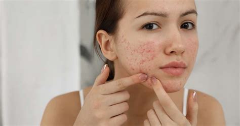 The Life Cycle Of Acne Formation And Effective Treatments