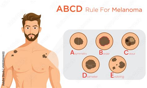 abcd rule for melanoma identifying asymmetry border color and