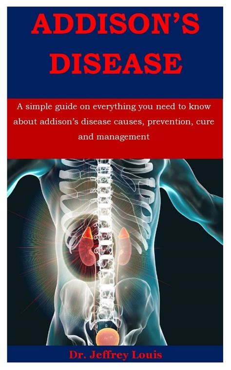 Buy Addisons Disease A Simple Guide On Everything You Need To Know
