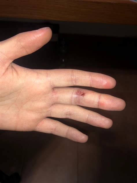 Chilblains Should I Do A Biopsy R Dermatologyquestions