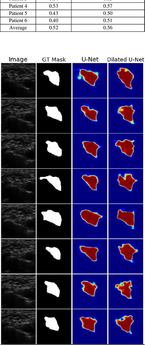 Figure 1 From Automatic Ultrasound Image Segmentation Of