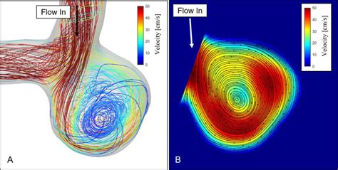 A 3d Cfd Velocity Streamlines Are Shown In The Aneurysm Sac And