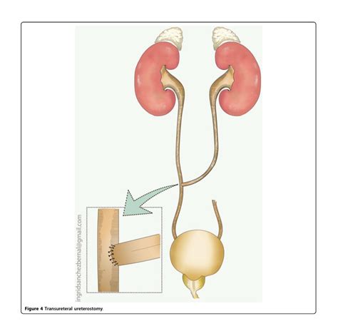 Ureterostomy