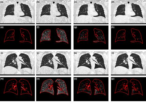 Figure 7 From Ultra‐low‐dose Ct Image Denoising Using Modified Bm3d Scheme Tailored To Data
