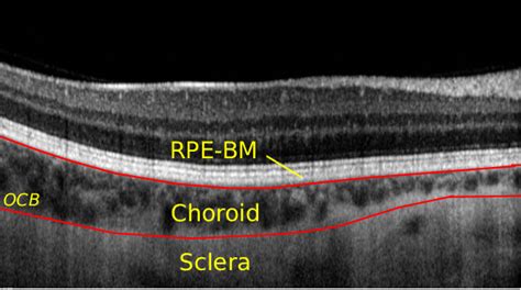 Sample OCT Image With Choroidal Layer Boundaries Marked In Red Download Scientific Diagram