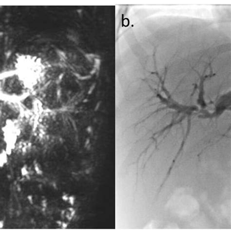 A Magnetic Resonance Cholangiopancreatography B Percutaneous Download Scientific Diagram