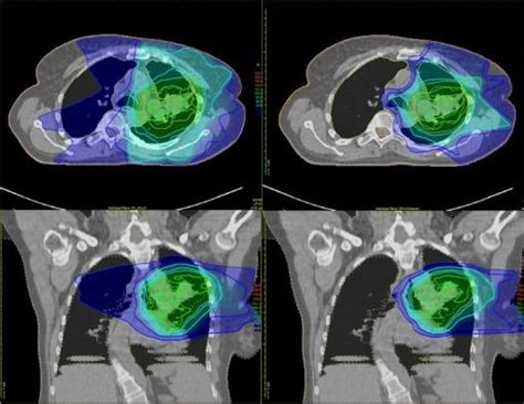 Proton Beam Radiotherapy Side Effects The Best Picture Of Beam