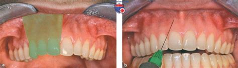 Методика местной анестезии фронтального отдела верхней челюсти