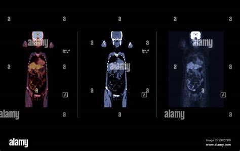 Pet Ct Image Of Whole Human Body Axial Coronal And Sagittal Plane