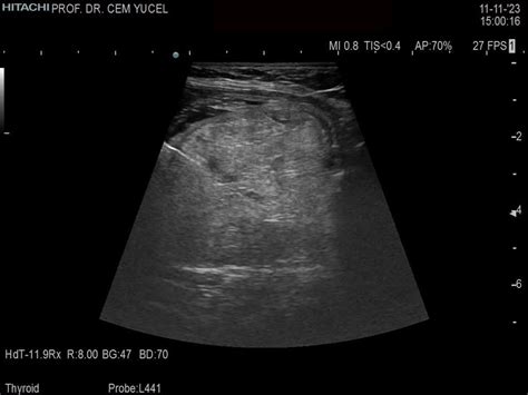 Cem Yucel On Linkedin Microwave Ablation Of A 90 Cc Thyroid Nodule With 15 Gauge Antenna For…
