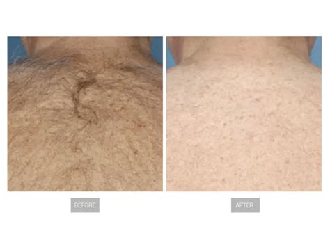 What To Expect Ipl Hair Removal Before And After Results Konmison