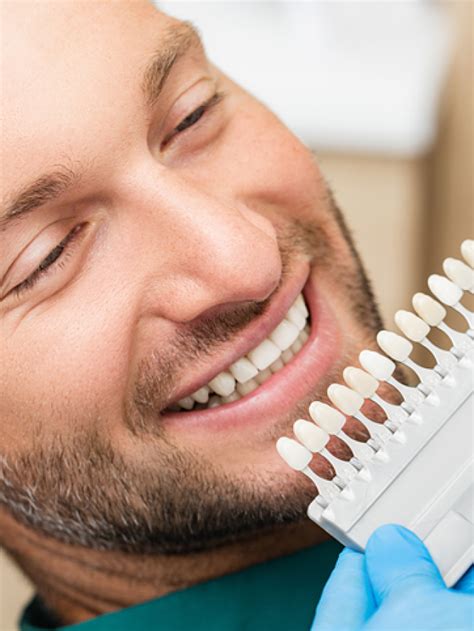 How Much Do Veneers Cost Can You Afford Them In Your Area Online