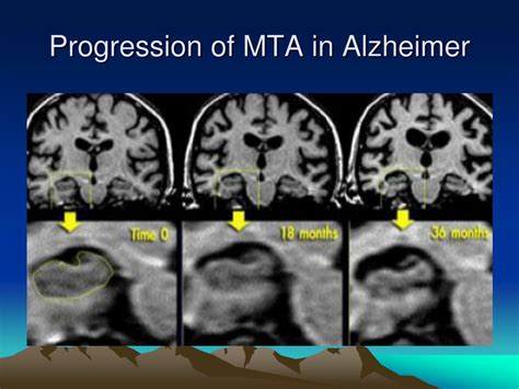 Ppt Dementia Powerpoint Presentation Free Download Id5490237