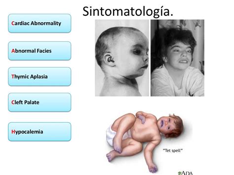 Sintomas De Síndrome De Digeorge Retoedu