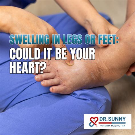 Swelling In Legs Or Feet Could It Be Your Heart Dr Sunny Malhotra