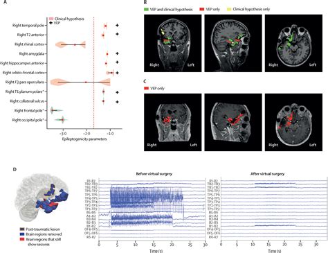 Personalised Virtual Brain Models In Epilepsy The Lancet Neurology