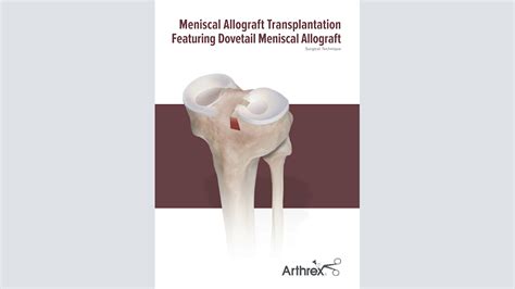 Arthrex Dovetailslot Meniscal Transplant Technique