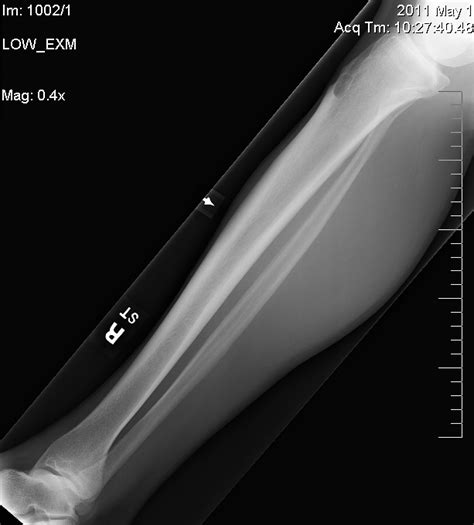 A 58 Year Old Man With A Right Proximal Tibia Lesion BoneTumor Org