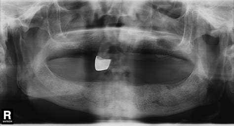 Dental Implantation On The Lower Jaw Alpha Dent Implants