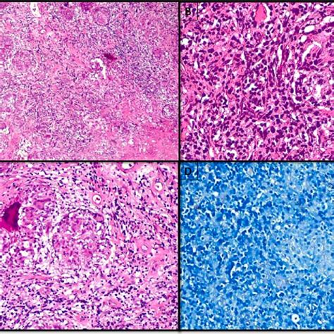 A C Hande Stained Sections Showing Granulomatous Granulomatous
