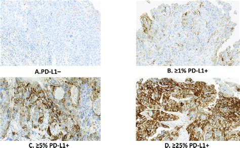 Tumor Pd L1 Expressed At Different Levels In Escc Specimens A Pd L1 Download Scientific