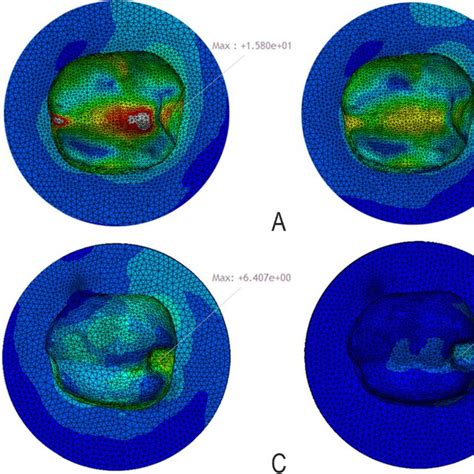 Mvm Stress Distribution Pattern For A Model D1z B Model D1f C Model