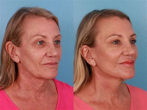 Patient 159280 Limited Incision Facelift Before And After Photos