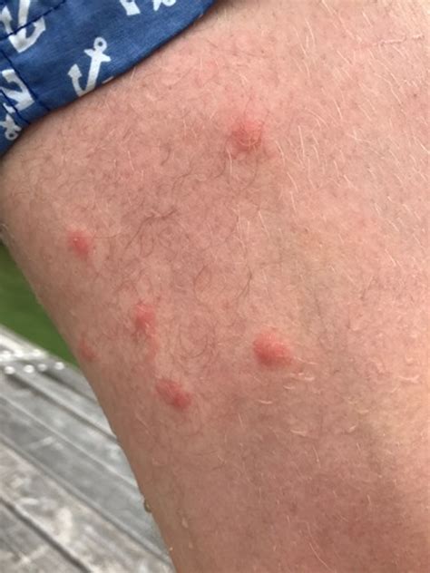 What Is Swimmer Itch Swimmers Itch What It Is Symptoms And