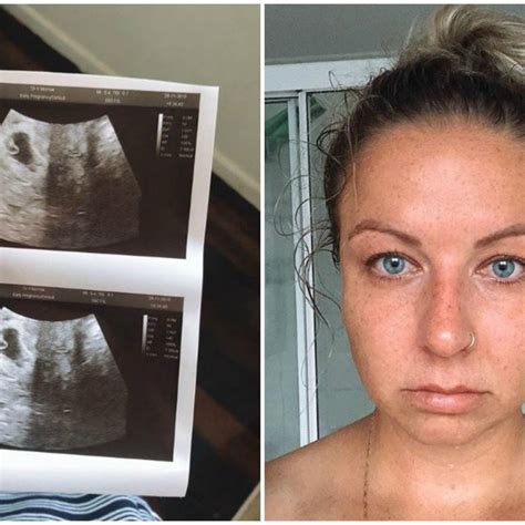 What Does A Miscarriage Look Like At 5 Weeks Ultrasound At Jeremy Shockley Blog