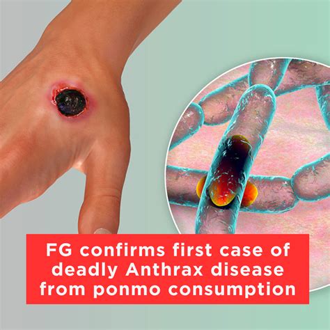 Fg Confirms First Case Of Deadly Anthrax Disease From Ponmo Consumption