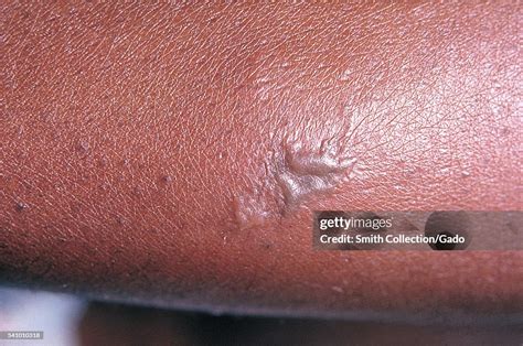 Close Up Of A Gonococcal Lesion On The Skin Of A Patients Arm 1963 Foto Di Attualità