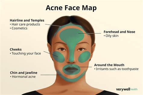 Forehead Acne Causes And Tips For Clear Skin