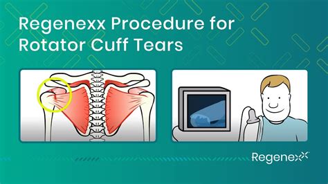 Regenexx Procedures For Shoulder Injuries And Arthritis Wasatch Pain
