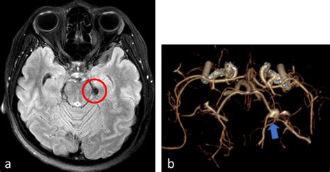 A The Patients Flair Sequence Of Brain Mri A Saccular Flow Void Is Download Scientific