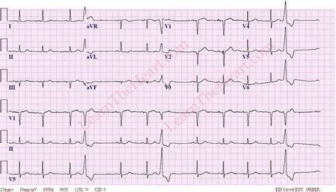 조기심실수축 부정맥 위험한 질환일까 네이버 블로그