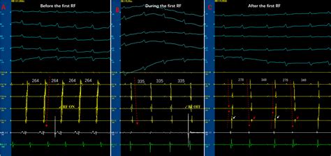 Irregular Tachycardia And Intra Atrial Conduction Block Of The Mitral Isthmus During Accessory