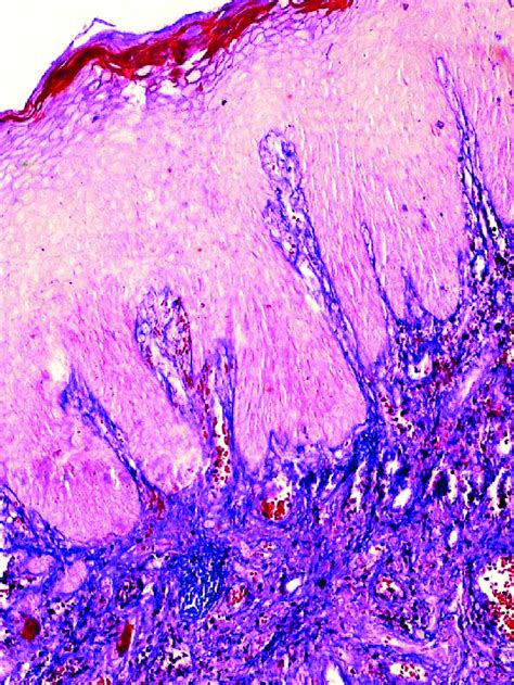 Hyperkeratinization Of The Surface Layer Of The Epithelium Keratin Is