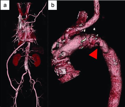 3dct A Aorto Femoral Bypass B Stenosis Within Elephant Trunk Red Arrows Download Scientific