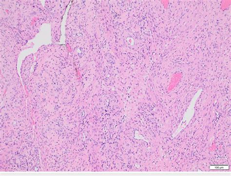 Low Power View Showing Nodular Multilayered Concentric Arrangement Of