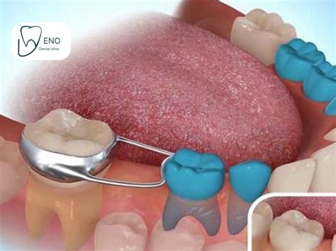 تغییر رنگ کامپوزیت دندان؛ آیا قابل درمان است؟ دندانپزشکی دنو