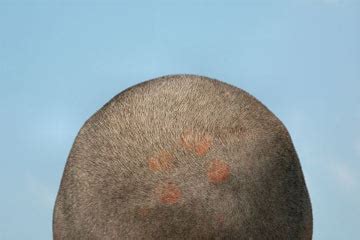 How Scalp Sores Work HowStuffWorks