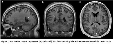 Signature Eeg Correlates On Intracranial Monitoring And Mr Guided Laser